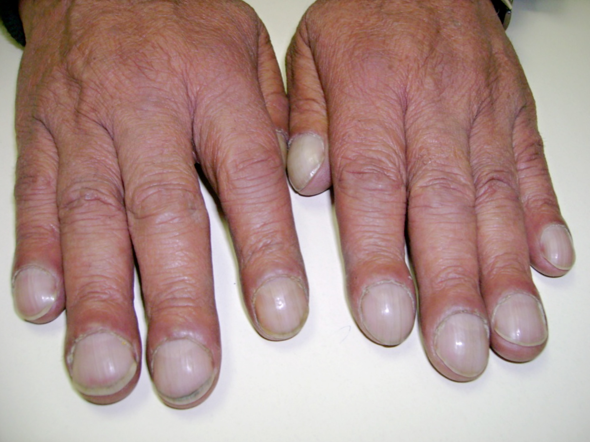 Ridges in Fingernails: 8 Health Warnings Your Fingernails May Be Sending