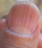 Ridges in Fingernails: 8 Health Warnings Your Fingernails May Be Sending