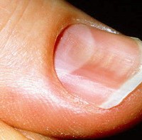 Ridges in Fingernails: 8 Health Warnings Your Fingernails May Be Sending